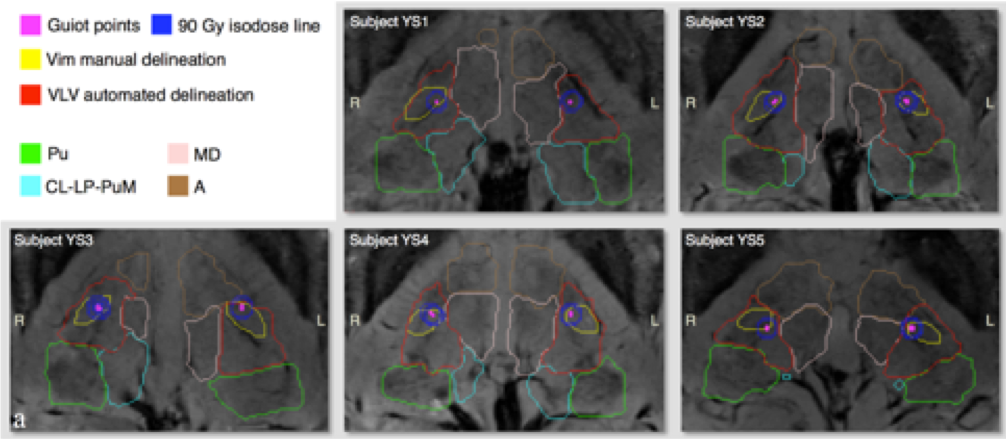3T and 7T MRI brain images: targeting the Ventro-intermediate thalamic ...