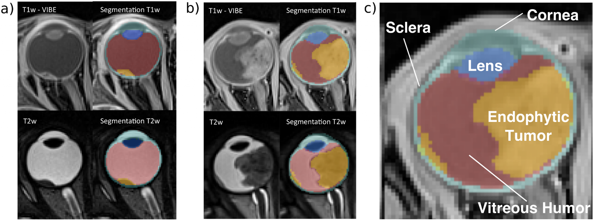 Multi-channel MRI segmentation of eye structures and tumors - Medical ...